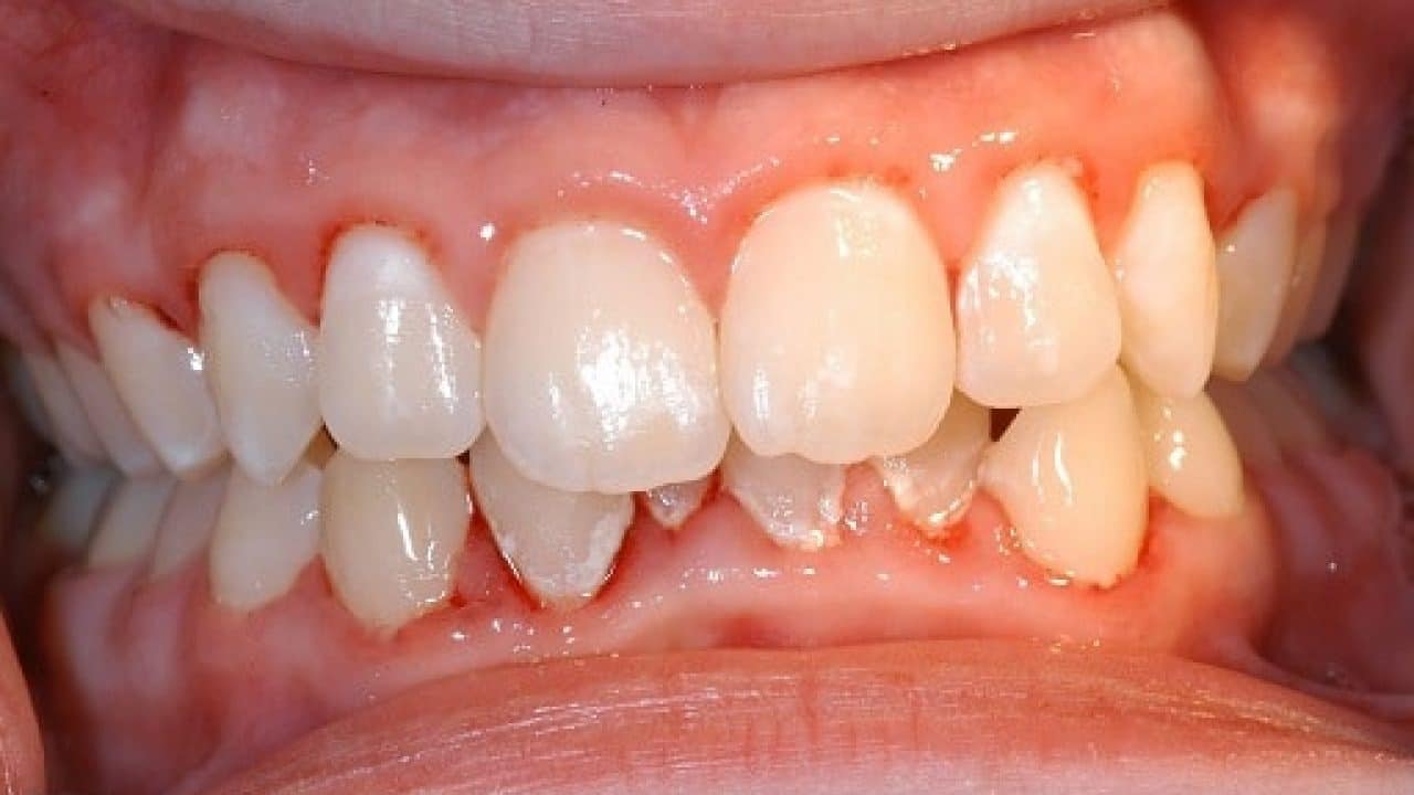 10 sinais de problema nas gengivas e dentes