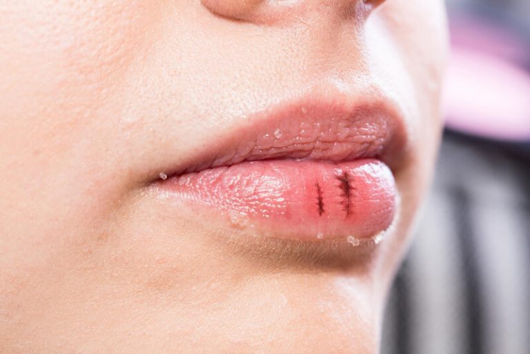 Inflamação dos lábios: causas, sintomas e tratamentos