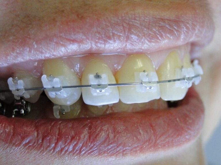 Aparelho autoligado: O que é, quando usar e diferenças do normal